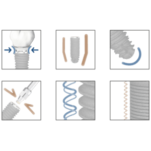 Bone Level Implant - TBR Dental